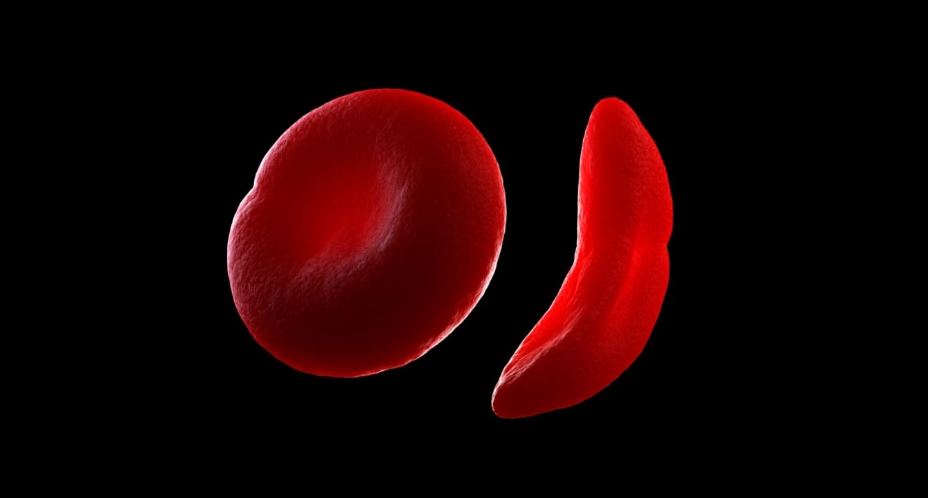 Recent stem cell transplant raises hope for sickle cell cure - Healthy ...